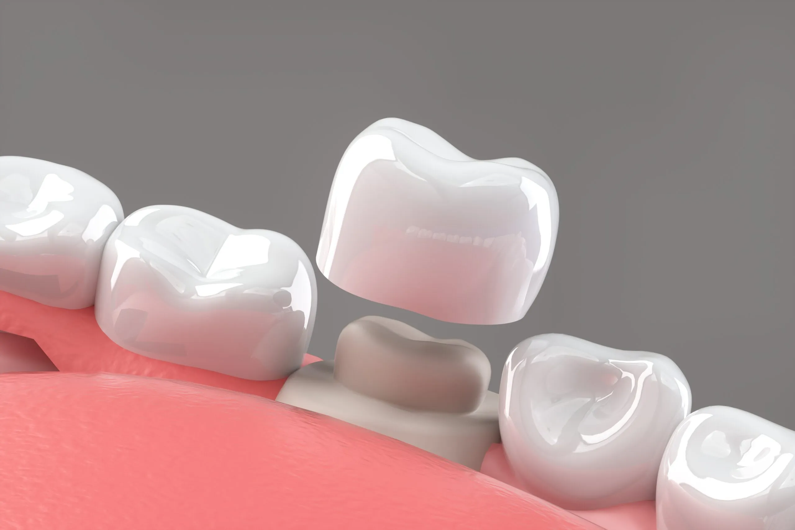 Can You Get Cavities Under a Dental Crown? Causes, Signs & Treatment