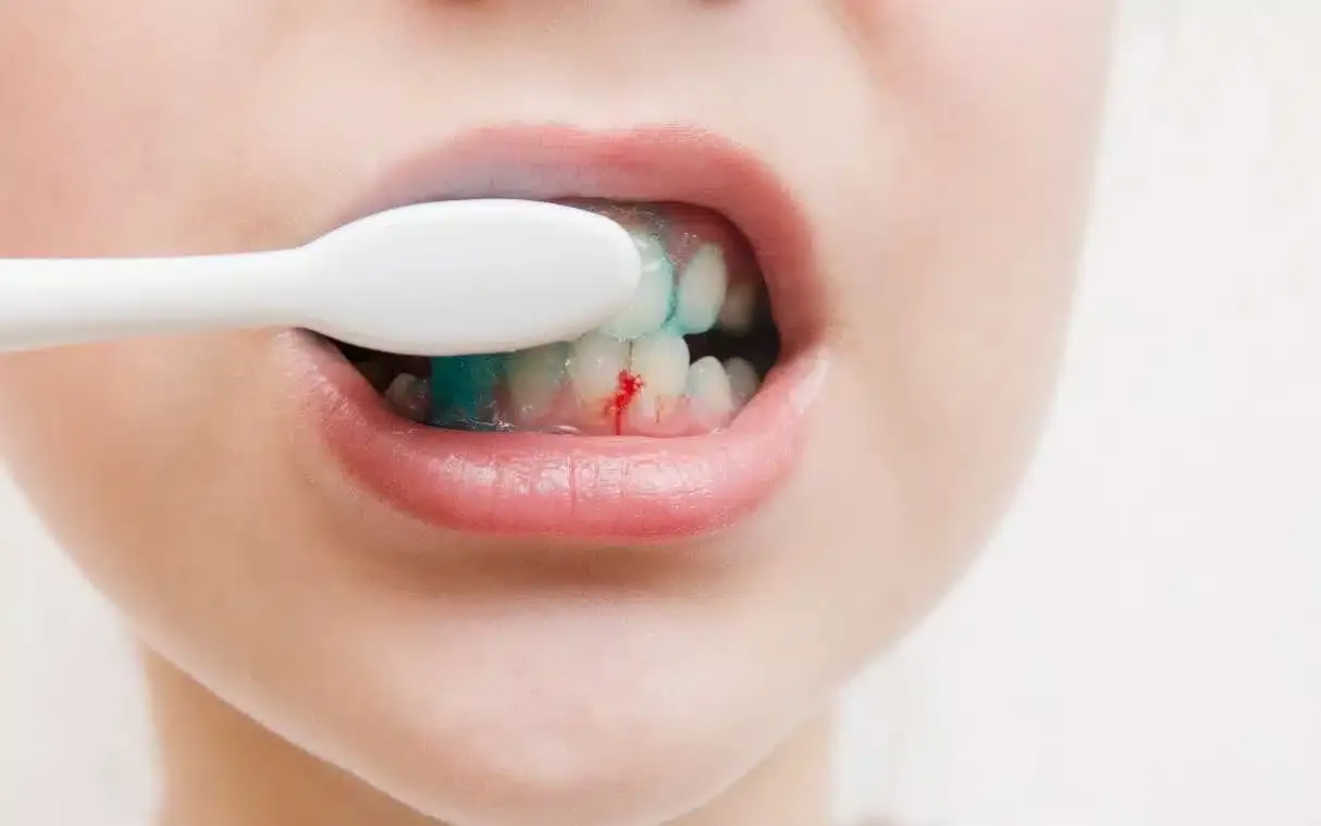 Why Do My Gums Bleed When I Brush? Causes, Treatment & Prevention Tips